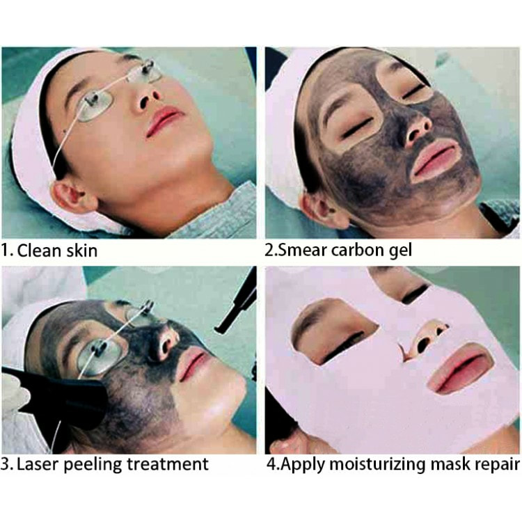 Carbon Laser Hollywood Skin Tightening Non Surgical Face Lift