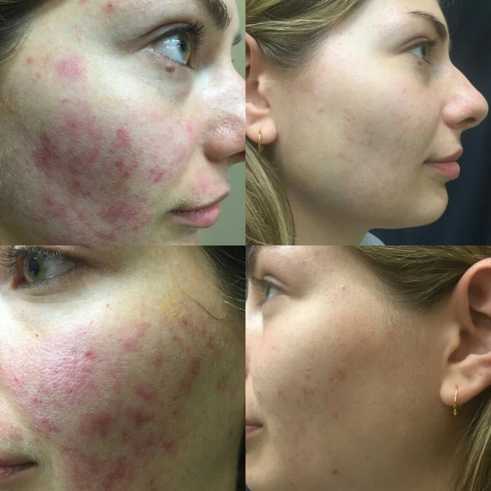 Carbon Laser Hollywood Skin Tightening Non Surgical Face Lift